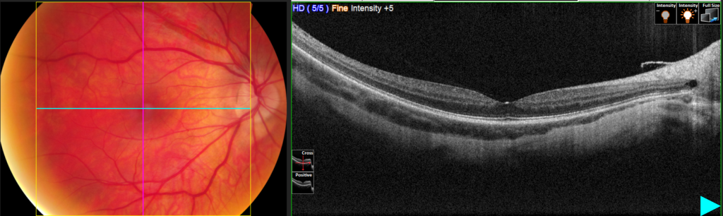 Your OCT 03 - EyeCarePD