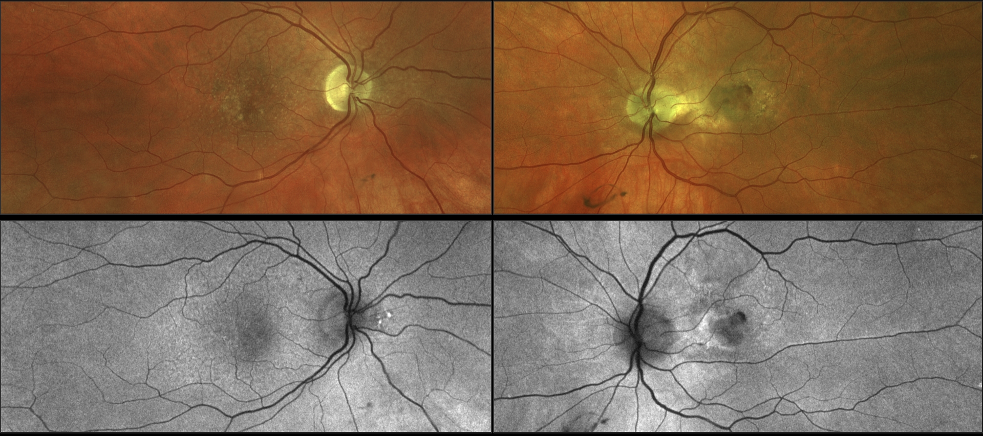 Charting Challenge 2 - EyeCarePD