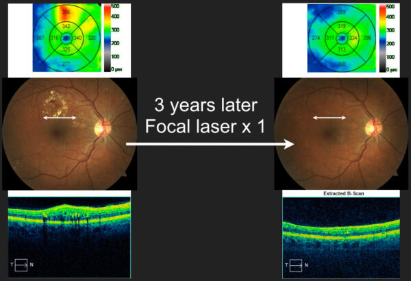 Macular Edema Case Examples - EyeCarePD