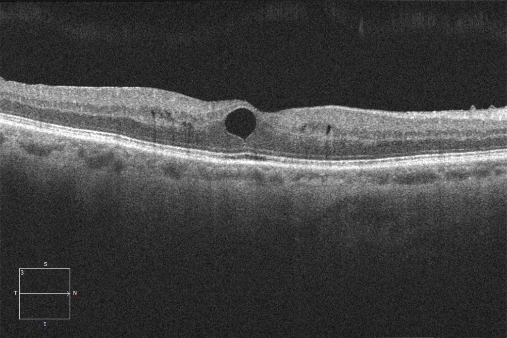 Cystoid Fluid Is it macular degeneration or a venous occlusion?