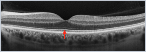 Ellipsoid Zone (EZ) - EyeCarePD