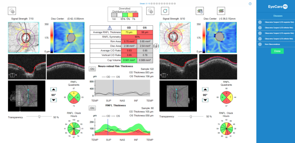 Interpret Glaucoma OCT Scans Like a Pro - EyeCarePD