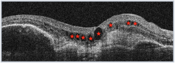 IRF: Intraretinal Cystoid Lesions - EyeCarePD