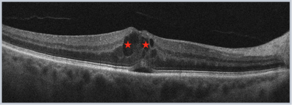 Intraretinal Fluid (IRF) - EyeCarePD