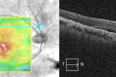 Keystone Exercises using Videos - EyeCarePD