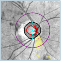 RNFL Deviation Map - EyeCarePD