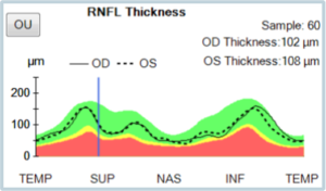 RNFL Graph: Basics - EyeCarePD