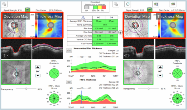 Where Is the RNFL Measured? - EyeCarePD