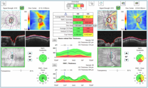 Glaucoma Suspect by OCT - EyeCarePD