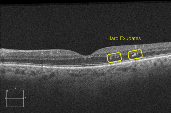 Nonproliferative Diabetic Retinopathy without Diabetic Macular Edema ...