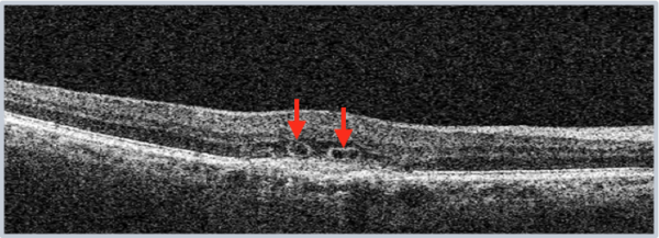 Outer Retinal Tubulations (ORT) - EyeCarePD