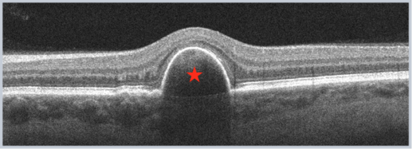 Pigment Epithelial Detachment (PED)