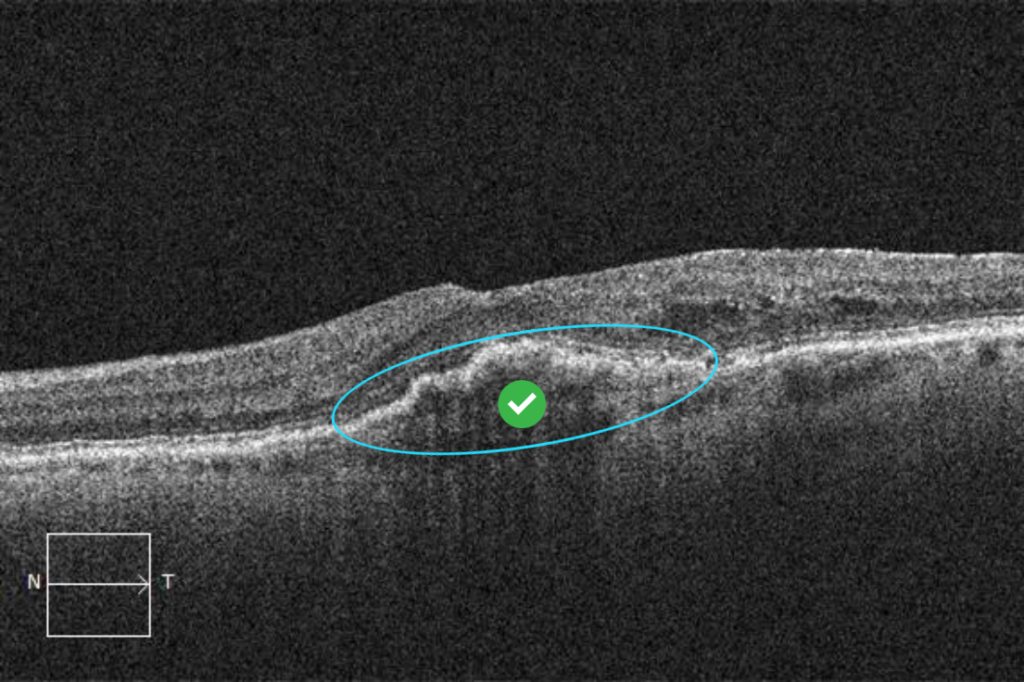 Pigment Epithelium Detachment