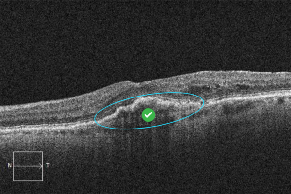 Pigment Epithelium Detachment - EyeCarePD