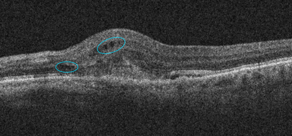 Is it really RAP? And why you should care. - EyeCarePD