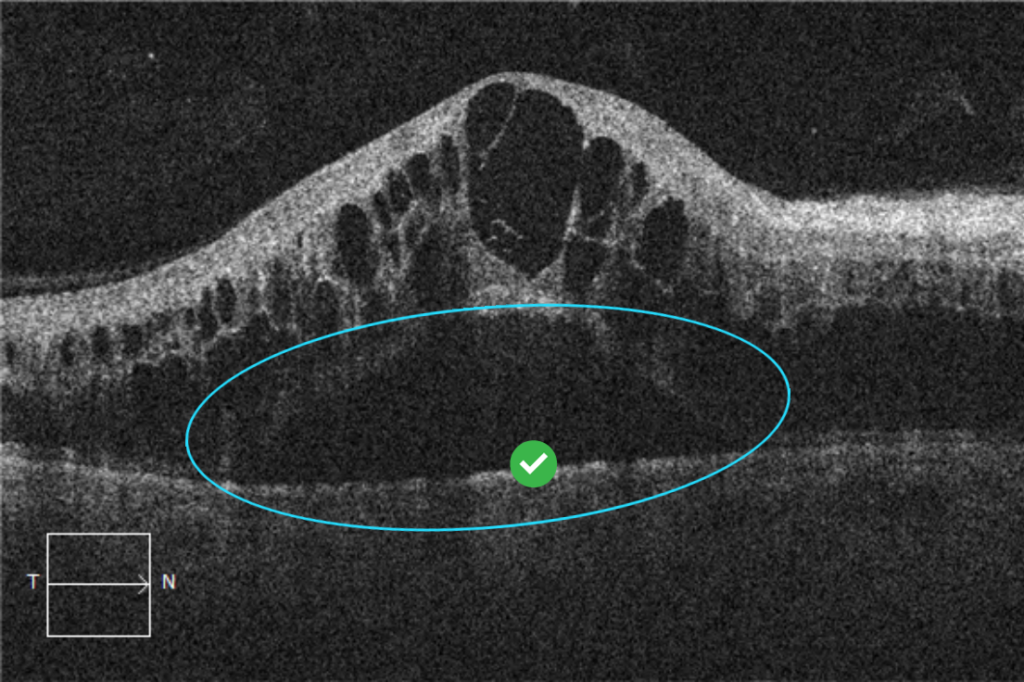Subretinal Fluid - EyeCarePD