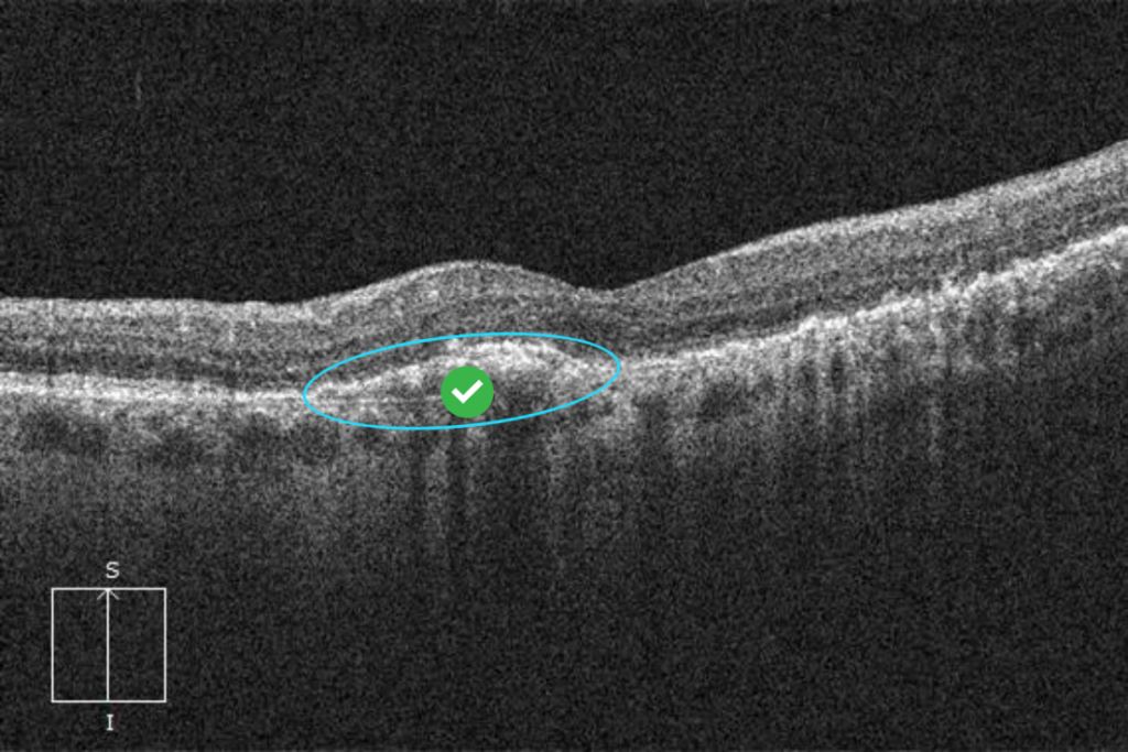 Subretinal Fluid vs. Pigment Epithelial Detachment - EyeCarePD