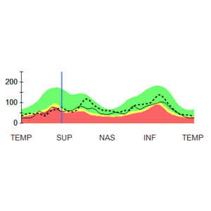 TSNIT graph Glaucoma-2 - EyeCarePD