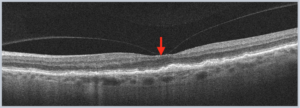 Vitreomacular Adhesion (VMA) - EyeCarePD