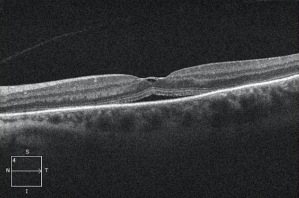Wait, is that really subretinal fluid? - EyeCarePD