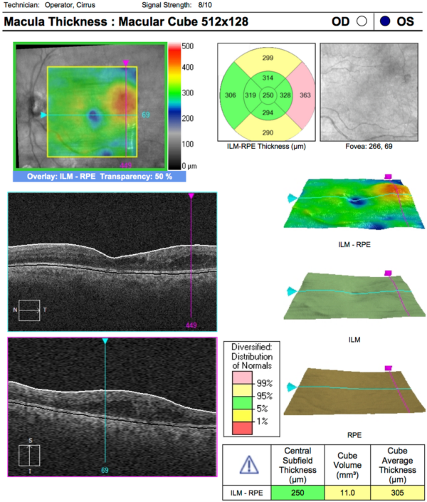 Is there ci-CSME (center-involving clinically significant macular edema ...