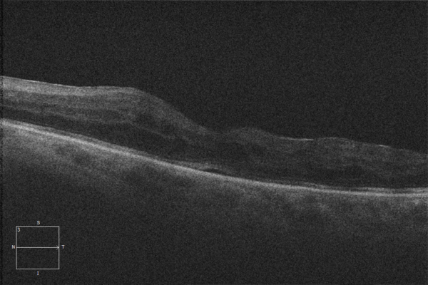 Chronic center-involving DME and a history of anti-VEGF and ...
