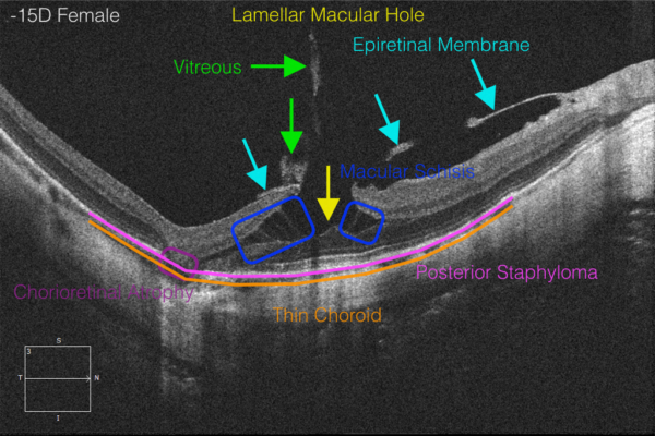 High Myopia plus Lamellar Macular Hole - EyeCarePD