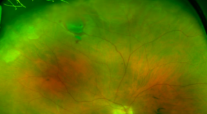 Horseshoe Retinal Tear - EyeCarePD