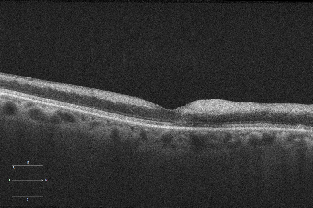 What you need to know about inner retinal opacification - EyeCarePD