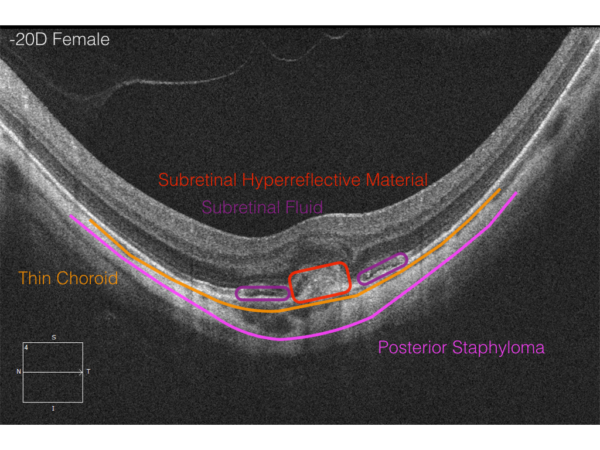 High Myopia with Choroidal Neovascularization (CNV) - EyeCarePD