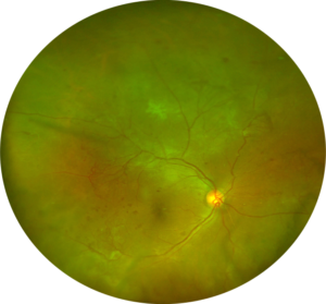 What is SHM and why is it important? - EyeCarePD