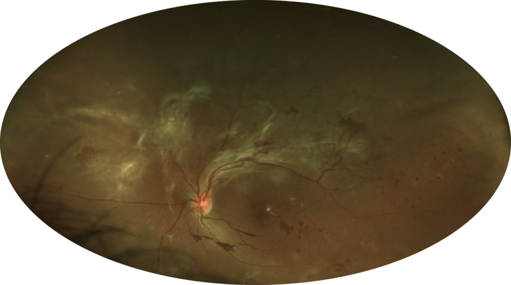 Proliferative Diabetic Retinopathy Pre- and Post-Panretinal ...