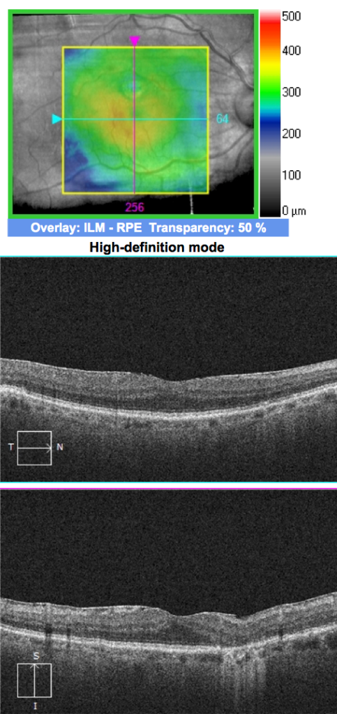 Why the color disparity? - EyeCarePD