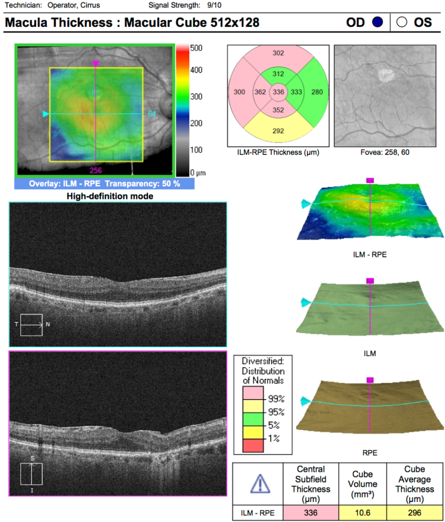 Why the color disparity? - EyeCarePD