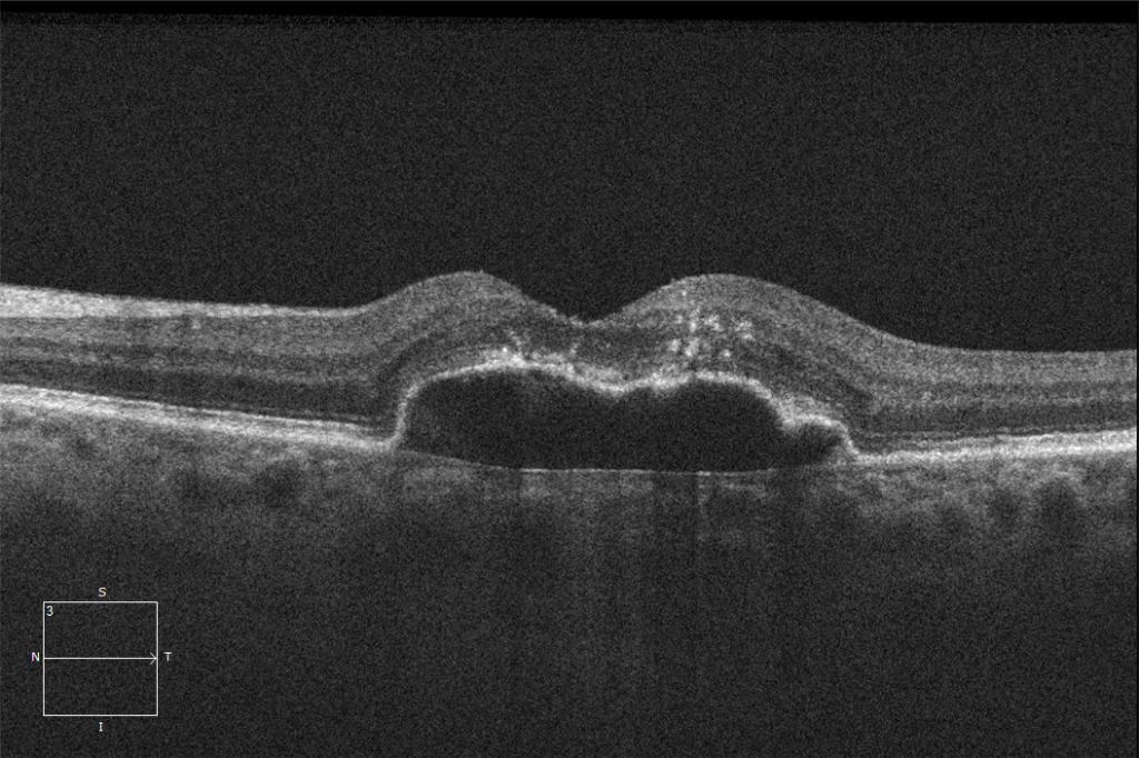 Serous Pigment Epithelial Detachment - EyeCarePD
