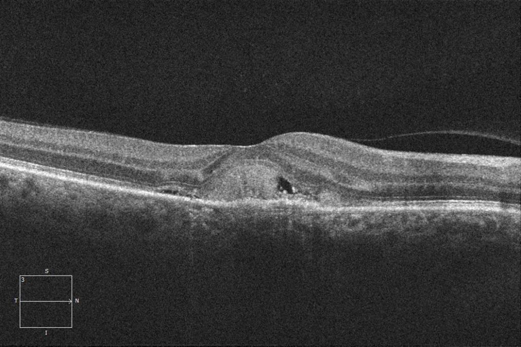 Wait, is that really subretinal fluid? - EyeCarePD