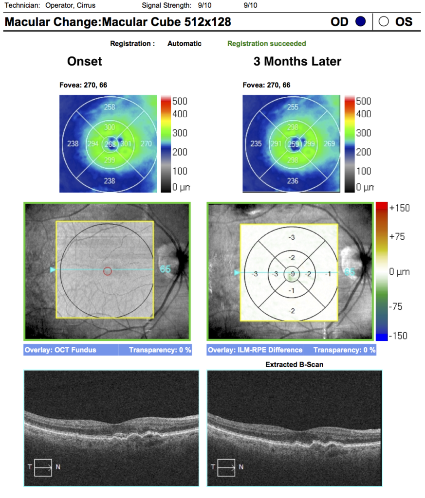 Is the OCT better, worse or the same?